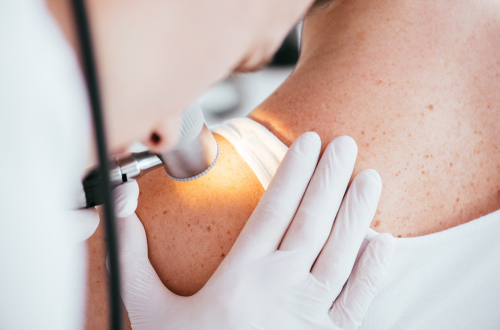 Top 5 Advances in Skin Cancer Research in 2024 - TFS HealthScience ...