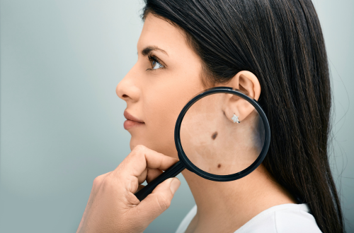 Skin Cancer Awareness Infographic | Download Infographic - TFS ...