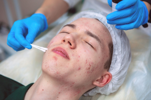 10 Clinical Trials for Acne Research - TFS HealthScience | Contract ...